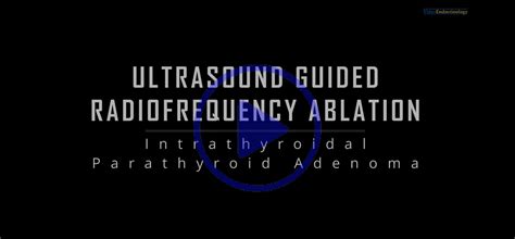 Radiofrequency Ablation Is A Sparing Technique For Treatment Of