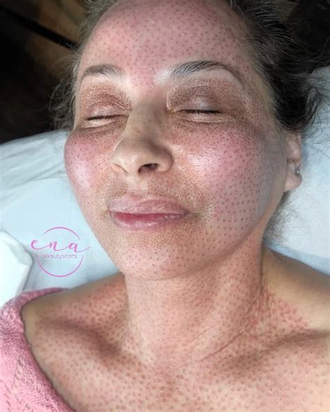 Cosmetóloga Con Isp Especialista En Fibroblast Con Plasmed