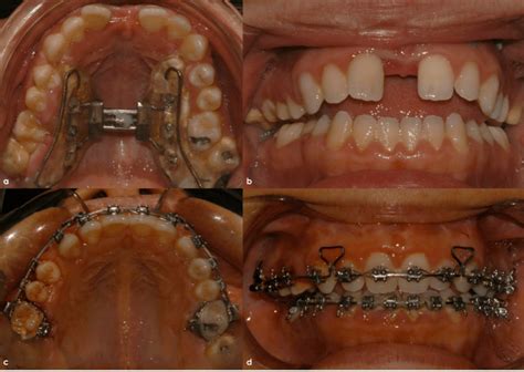A B Intraoral Exploration At The Beginning Of The Disjunction C D