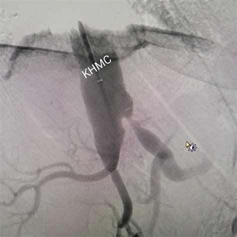 Dr Samer Al Jfoot Samer Interventional Radiology • Instagram Photos And Videos