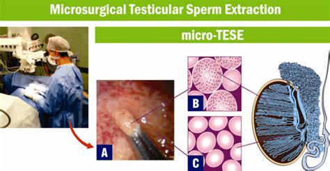 Micro Tese Microscopic Testicular Sperm Extraction