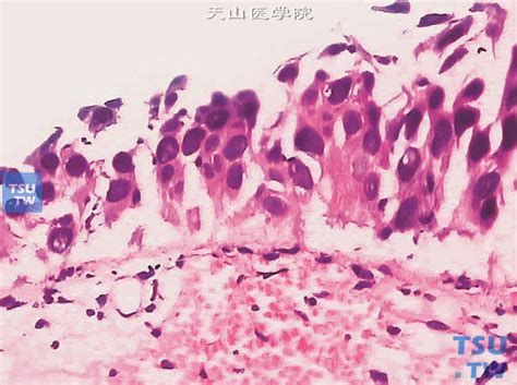 膀胱原位癌病理图谱 泌尿系统 天山医学院