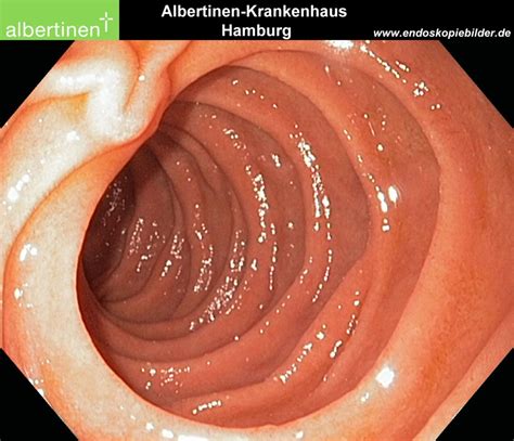 Duodenum Desc Normal Endo Doccheck