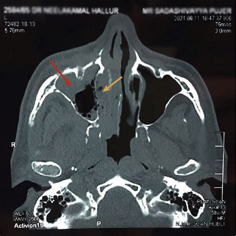Axial Section Of Ct Showing Hyperdense Mass Filling The Right Maxillary