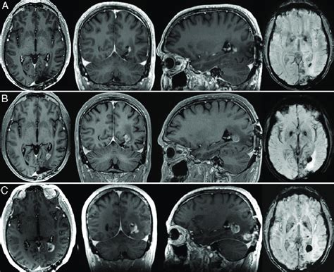 Surveillance Mri A Showed A Focal Enhancing Nodularity Within The