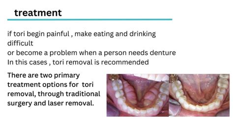 Tori Palatinus Tori Madibularis And Treatment Pptx Dental Health