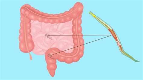 Pinworm Infection Causes Symptoms Diagnosis Treatments Page 10 Entirely Health