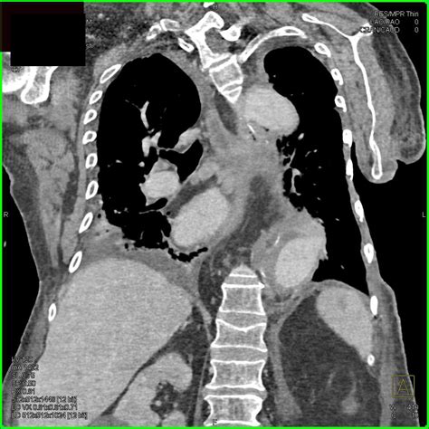 Mediastinal Abscess Chest Radiology Case Studies Ctisus Ct Scanning