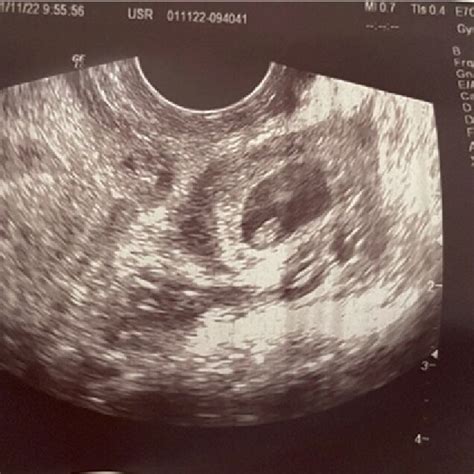 Ultrasound Photography Of The Ectopic Gestational Sac With Its Yolk Sac Download Scientific