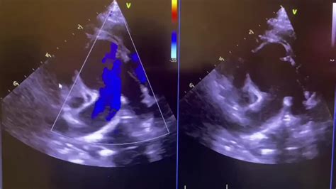 Truncus Arteriosus Type One Dear Colleagues Gorgeous Cardiac Case… Professor Dr Ahmad Zaki Alani