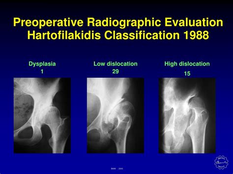 Ppt Charnley Low Friction Arthroplasty For Osteoarthritis Powerpoint