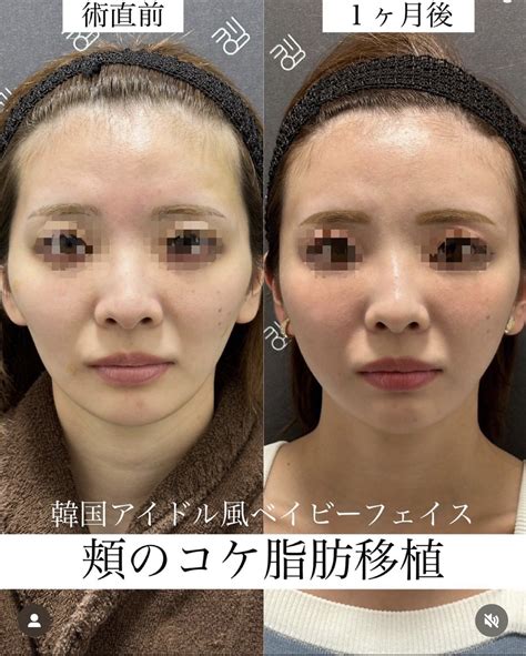 💉【頬のコケ脂肪注入】1ヶ月後 Emmo Face Clinic