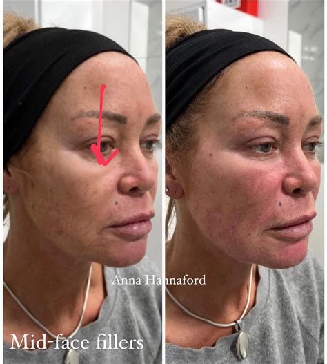 Transformations Anti Wrinkle And Dermal Fillers Before And After
