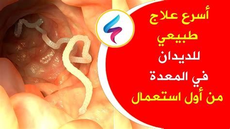 علاج فوري لديدان المعدة والامعاء والتخلص نهائيا من السموم أفضل علاج