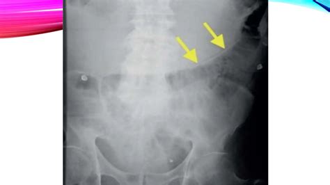 Acute Mesenteric Ischemia Anatomy Pathophysiology And Management Pptx