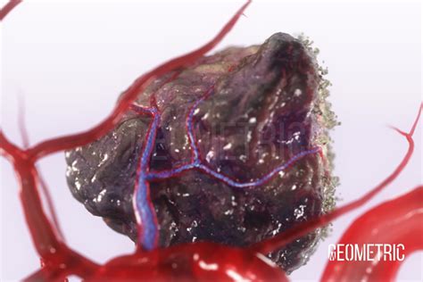 Chemoembolization Embolization Animation Geometric Medical