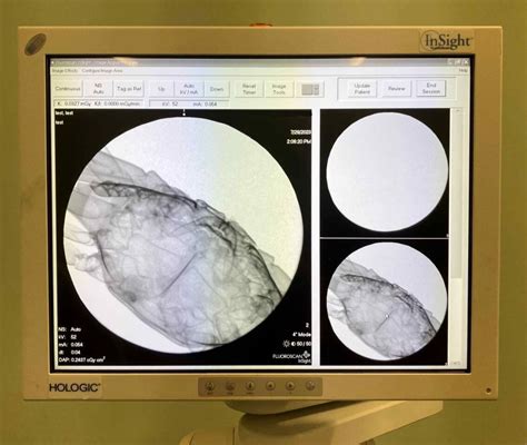 Used Hologic Fluoroscan Insight 2 Mini C Arm For Sale Dotmed Listing