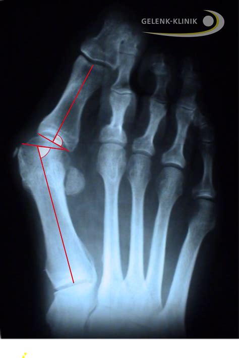 Hallux Valgus A Minimally Invasive Surgery Corrects The Position Of