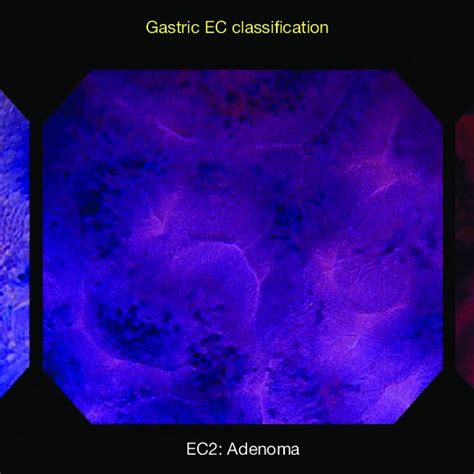 Gastric Ec Classification Representative Pictures Differentiating Ec1