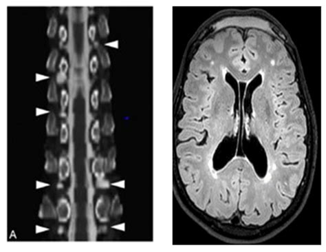 Atypical Presentation Of A Severe Form Of Spontaneous Intracranial