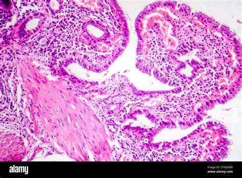 Chronic Cholecystitis Cholecystitis