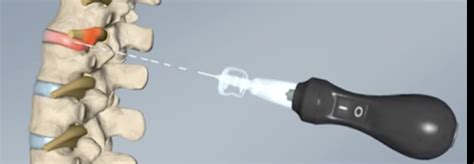 Percutaneous Discectomy 7 Powerful Benefits