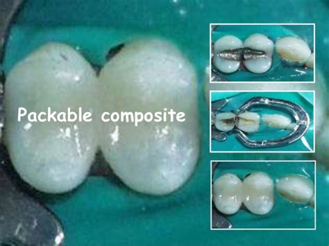Packable Composite Dental