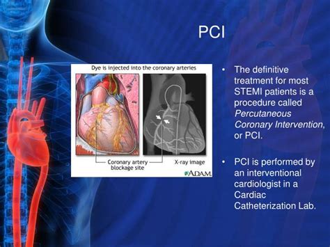Ppt Stemi Powerpoint Presentation Id 1423479