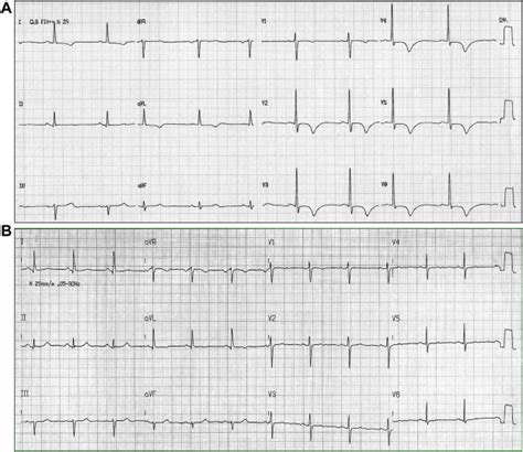Left Septal Fascicular Block Evidence Causes And Diagnostic Criteria Heart Rhythm