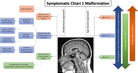 Clinical Manifestations Of Chiari I Malformation Neurosurgery Clinics