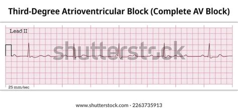 56 Third Degree Atrioventricular Block 图片、库存照片和矢量图 Shutterstock