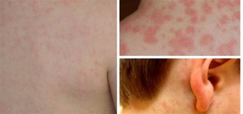 Amoxicillin Rash Types Causes Symptoms And Treatments