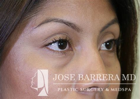 Blepharoplasty Case 3744 Dr Jose Barrera San Antonio Facial Plastic Surgeon And Ent
