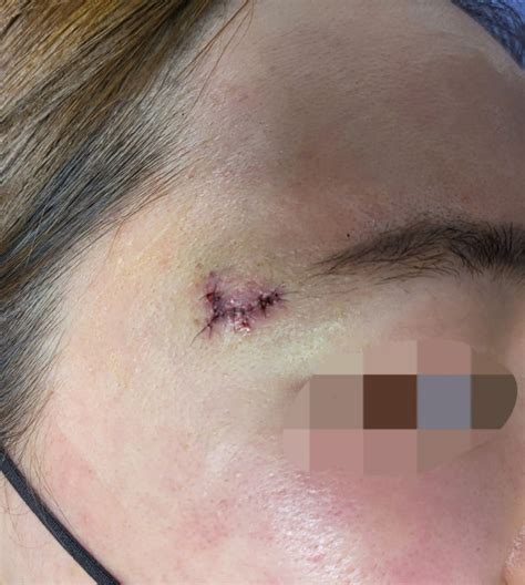 흉터레이저 후기 한강수병원 얼굴 열상 수술 외상 울트라펄스 실비보험 1탄 네이버 블로그