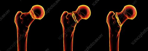 Femur Neck Fracture Types Illustration Stock Image F043 9254 Science Photo Library