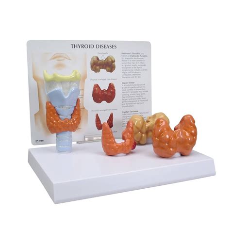 Gpi Anatomicals Thyroid Disease Anatomy Model