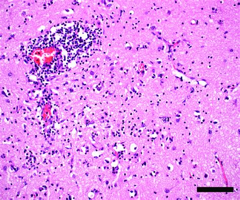 Temporal Neocortex Showing Encephalitis With Perivascular And Download Scientific Diagram