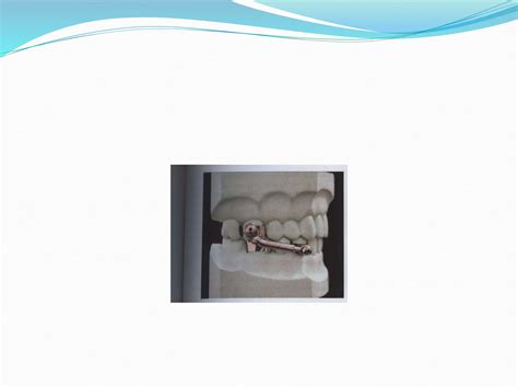 Fixed Functional Appliances In Orthodontics Pptx