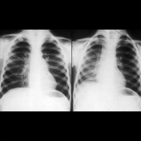 School Ager Who Started Coughing After Eating Peanuts Pediatric