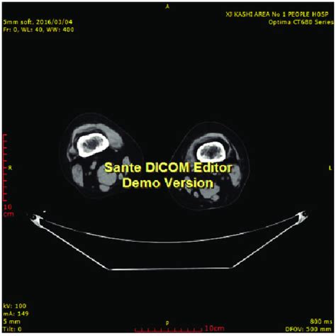 2d Image Of A Cross Section Of The Tibia The Tilt Was 0 Wl Was 40 Mm Download Scientific