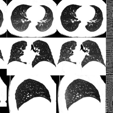 Examples Of Rrn Registration On A Pair Of Lung Ct Scans From Dirlab Download Scientific Diagram