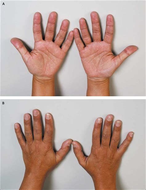 Addisons Disease The Lancet