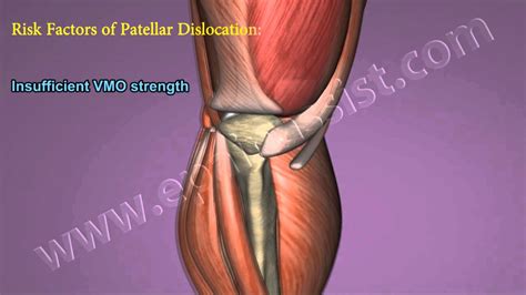 Patellar Dislocation Or Subluxation Causes Risk Factors Treatment