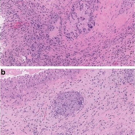 Case 2 Subchondral Bone Cysts In Both Femoral Head And Acetabulum With