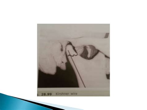 Condylar Fracturepptx