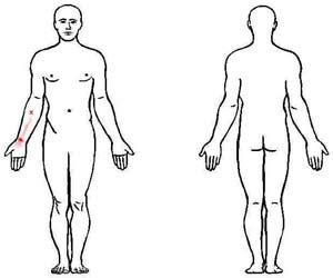 Flexor Carpi Radialis Trigger Point