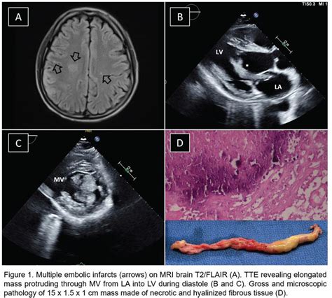 Acute Embolic Stroke Secondary To Prolapsing Left Atrial Mass In A Patient With Synovial Sarcoma