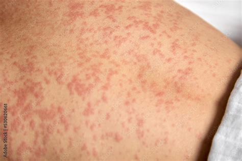 Red Rash On Shoulders Back And Chest At Alyssa Wekey Blog