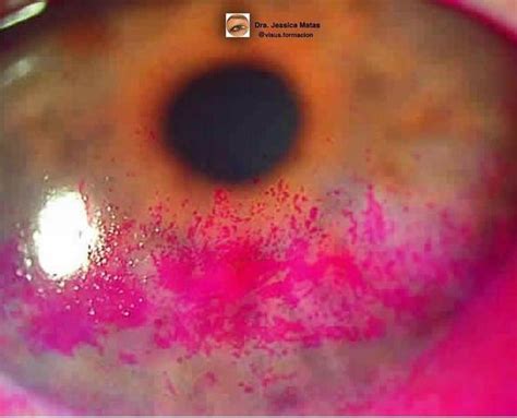 Zahra Medicare On Linkedin Superficial Punctate Keratitis Spk ️spk