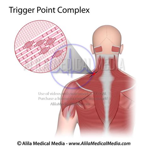 Alila Medical Media Trigger Point Complex Unlabeled Medical Illustration